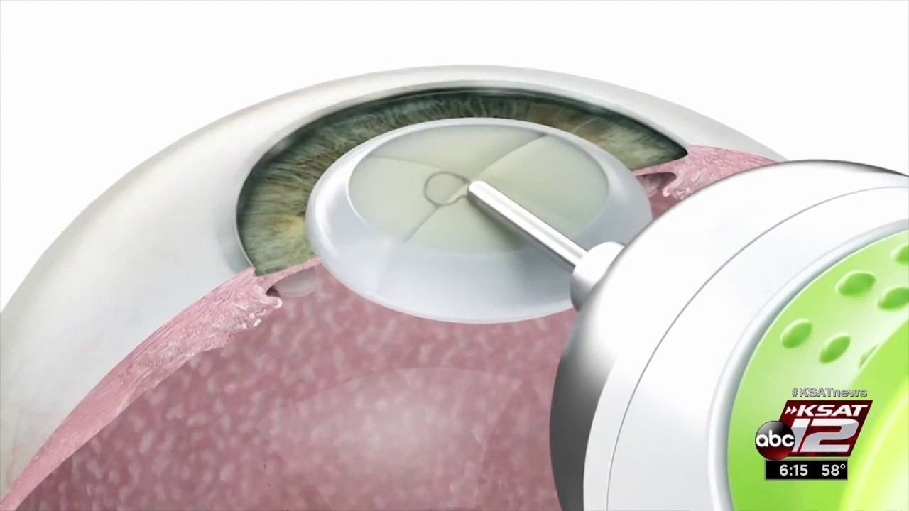 Miloop Removes Cataracts In A Flash